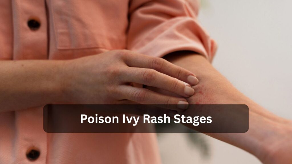 Poison Ivy Rash Stages - Epic Urgent & Family Care